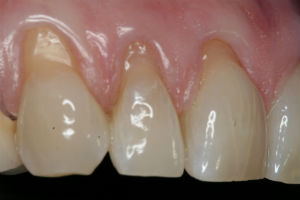 Root Coverage Grafting Orange CA, Michael J. Arzouman, D.D.S., Inc.