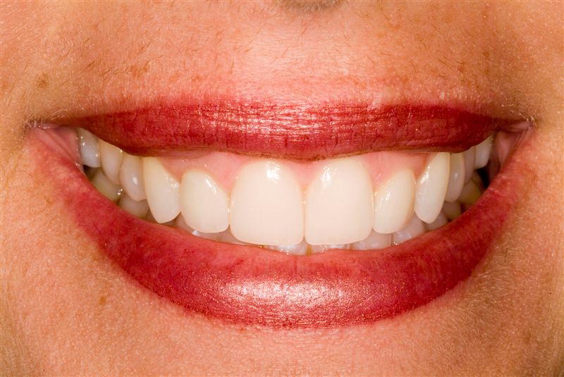 Crown Lengthening Orange CA, Michael J. Arzouman, D.D.S., Inc.